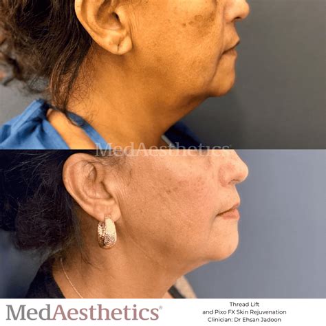 Pico Genesis FX Perth Medaesthetics Cosmetic Skin Clinic