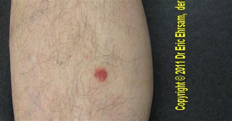 Dermoscopy A Red Tumor On A Leg