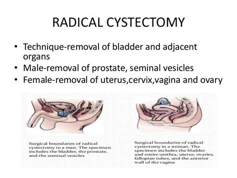 Radical Cystectomy