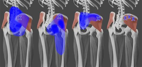 Acupuncture For Gluteus Medius Pain Morningside Acupuncture NYC