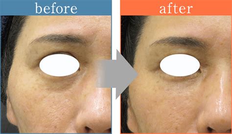 【切らないクマ取り】prpf再生療法で目元がパッと若返る！ たにまちクリニック｜上本町（大阪）にある美容クリニック