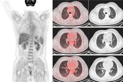 A Case Of Multiple Pulmonary Metastasizing Pleomorphic Adeno Chinese Medical Journal