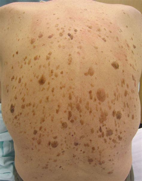 Seborrheic Keratosis Alchetron The Free Social Encyclopedia