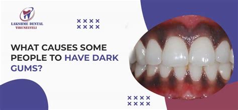What Causes Some People To Have Dark Gums Dental Clinic In