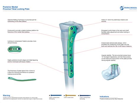 Proximal Tibia Plate
