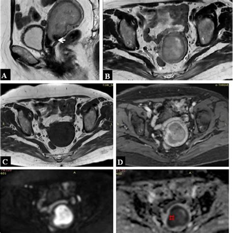 75 Year Old Patient With Grade I Endometrial Carcinoma On Top Of
