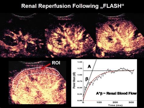Assessment Of Renal Tissue Perfusion By Low Power Real Time Download Scientific Diagram