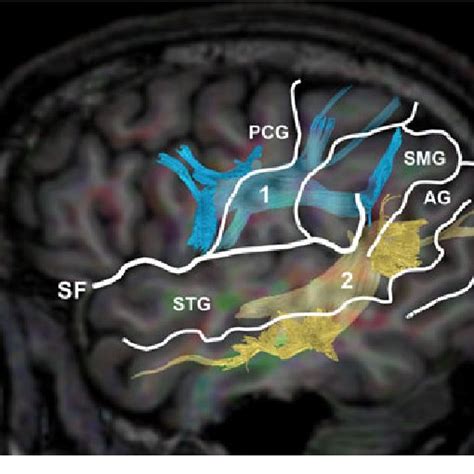 Fiber Dissection And Dti Tractography Reconstruction Of The Long