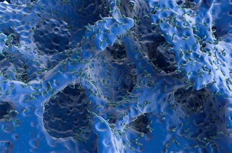 Bone Cancer Osteosarcoma Closeup View 3d Illustration Stock Illustration Illustration Of