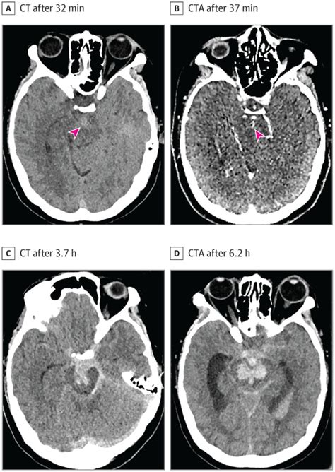 Jama Neurology On Linkedin Ct Findings In Hyperacute Spontaneous Midbrain Hemorrhage