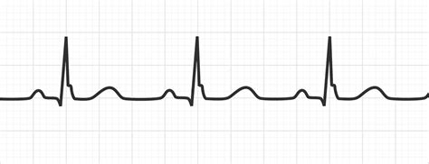 Hypercalcaemia On Ecg Ecg Disease Patterns Medschool