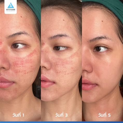 ก่อนและหลังทำเลเซอร์ Pico Laser ต้องปฏิบัติตัวอย่างไรบ้าง ให้ผลลัพธ์