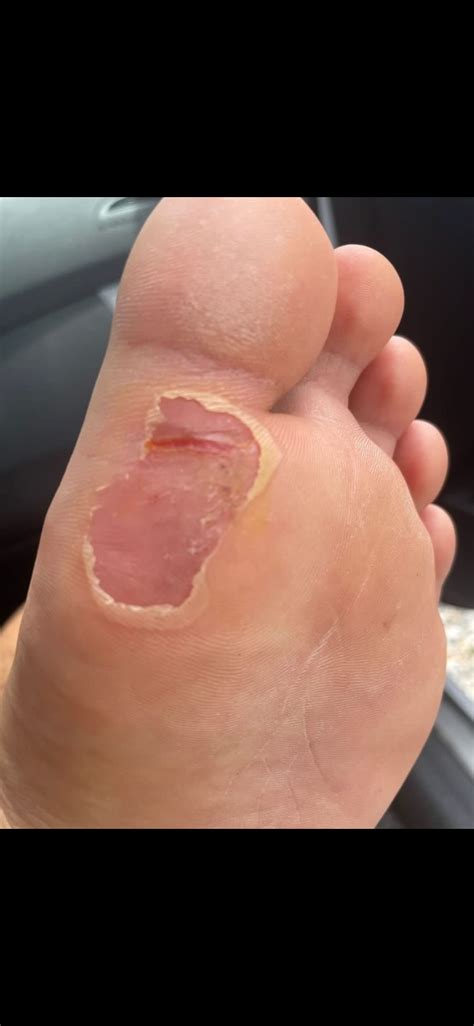 발바닥 물집 물놀이 지식in