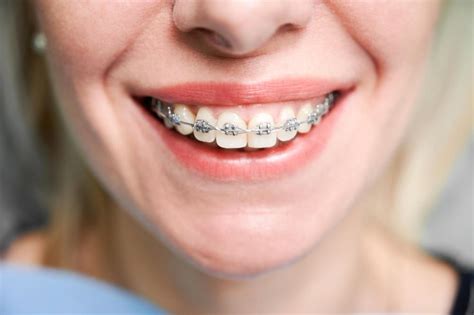Best Braces Colors Pick The Best Color For You Smart Orthodontics