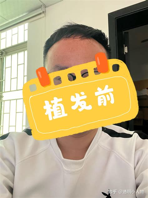 植发 知乎