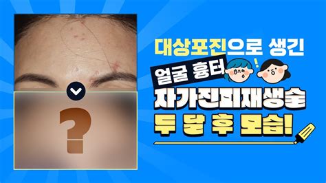 대상포진 앓고 난 뒤 생긴 얼굴 흉터 자가진피재생술 두 달 뒤의 모습은 Youtube