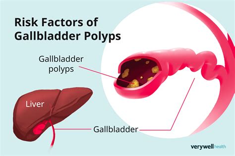 What To Know About Gallbladder Polyps