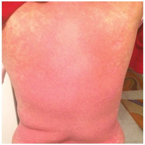 Generalized Maculopapular Rash Download Scientific Diagram
