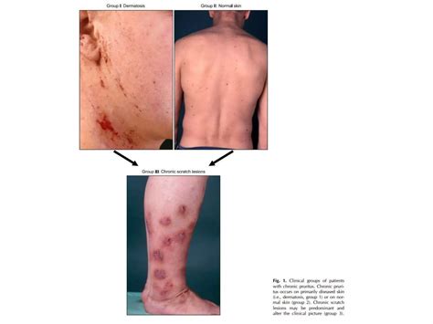 Acquired Perforating Dermatosis And Lichen Amyloidosis Pptx