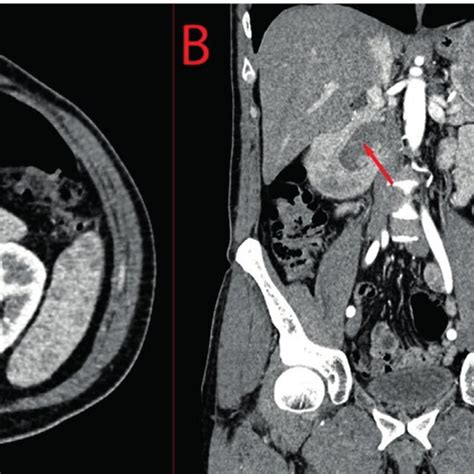 Abdominal Ct Showing Large Diverticulum That Compresses The Pancreas Download Scientific