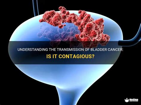 Understanding The Transmission Of Bladder Cancer Is It Contagious Medshun