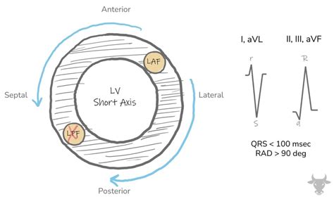 Left Posterior Fascicular Block ECG Stampede