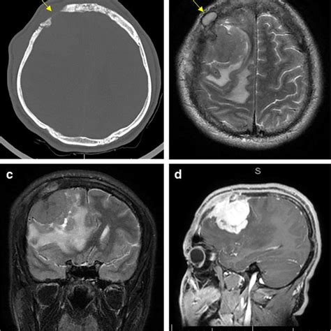 A 57 Year Old Male Patient With A Previous Left Pterional Craniotomy Download Scientific