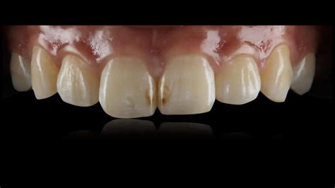 Icon Resin Myzerodonto