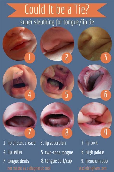 Lip And Tongue Ties How To Check For One Revision Tips And Post
