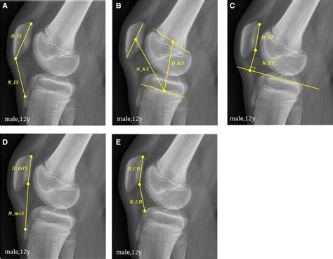 Frontiers Evaluation Of Age Group And Sex Differences In The Measurement Of Patellar Height Of