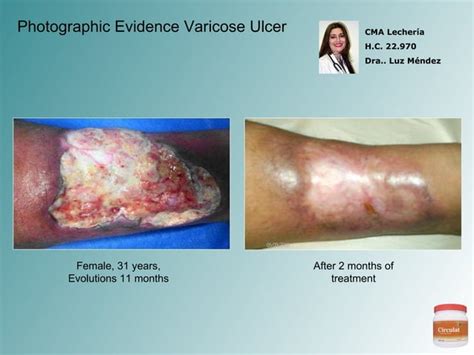 Varicose Ulcer Evidence Part I Circulat Ppt