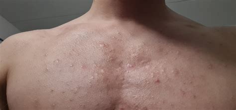 White Bumps On Chest Male