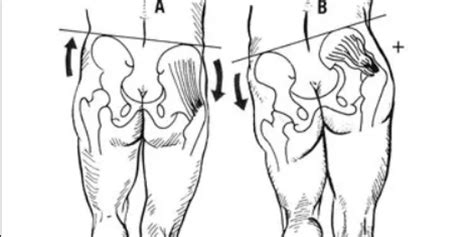 골반 비대칭의 핵심 근육 강화하는 이 운동 더베네핏