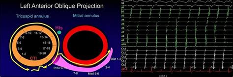 Cavotricuspid Isthmus Dependent Atrial Flutter Beyond Simple Linear Ablation Michael Wang