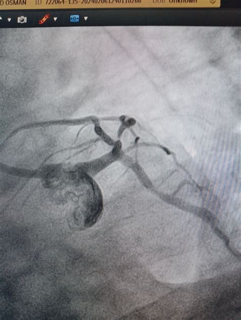 Hisham Gabr On Linkedin Successful Mini Crush Technique In Lad D1 Bifurcation Lesion 65 Y O…