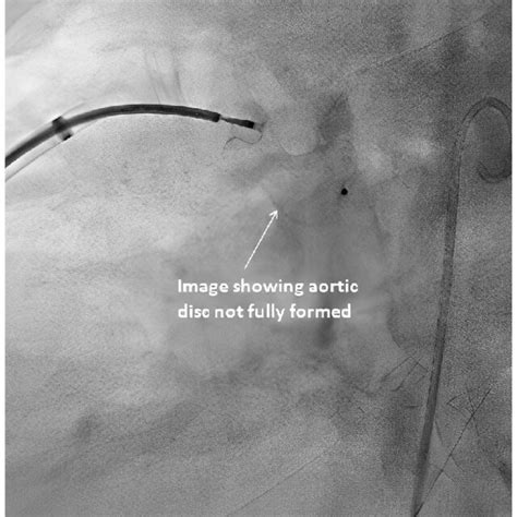 Lateral View On Fluoroscopy Showing Aortic Disk Of 16 × 14 Amplatzer Download Scientific