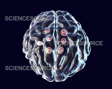 Cryptococcal Brain Lesions Illustrati Stock Image Science Source Images