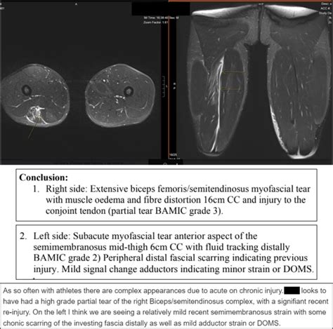 Hamstring Strength At Every Length Targeting Hip Extension Sportsmith