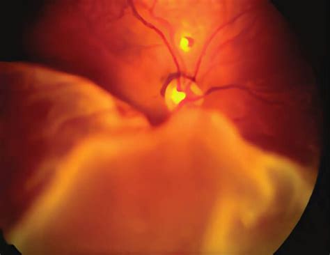 Retinal Consultants Medical Group Inc On Linkedin Retinacare