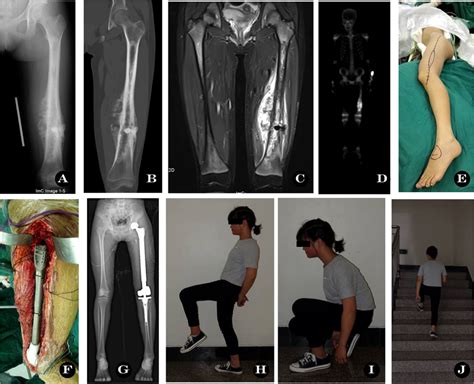 Total Femoral Prosthesis Replacement A 15 Year Old Girl With Left Download Scientific Diagram