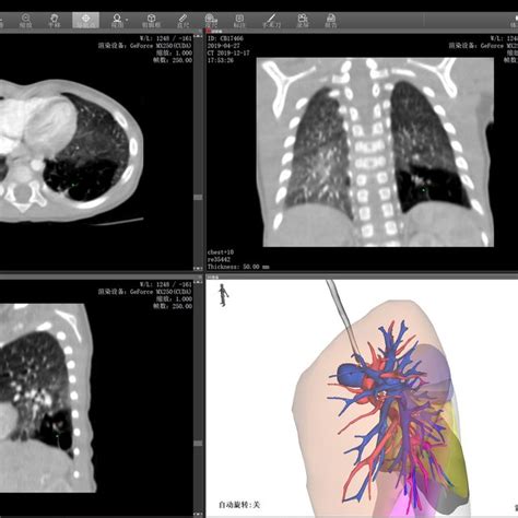 The Application Of Virtual Segmentectomy Based On Three Dimensional Computed Tomography And