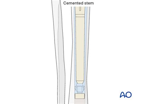 Proximal Tibia Replacement For Fracture Around A Loose Tibial Component With Poor Bone Stock