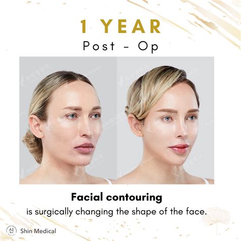 Facial Contouring Can Be Done A Variety Of Ways Genioplasty Chin Reduction Square Jaw