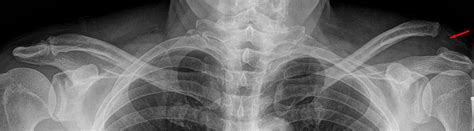 Shoulder Dislocation Vs Shoulder Separation Doctor Schierling