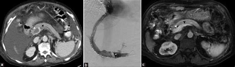 Transjugular Intrahepatic Portosystemic Shunt For Maintenance Of Portal Venous Patency In Liver
