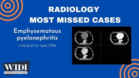 Most Missed Cases Emphysematous Pyelonephritis Youtube