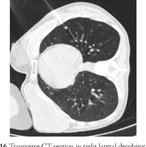 Figure 16 From Management Of Incidental Lung Nodules