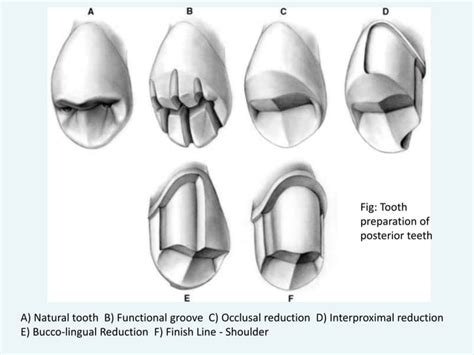 Design Of A Fixed Partial Denture With Abutment Tooth Preparation Pptx Dental Health