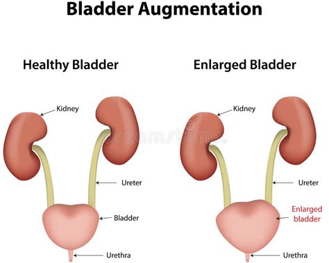 Bladder Augmentation Labeled Diagram Stock Vector Illustration Of