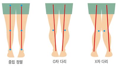 성장기 아이의 다리 건강 알아보기 메디컬칼럼 건강이야기 건강정보 서울아산병원